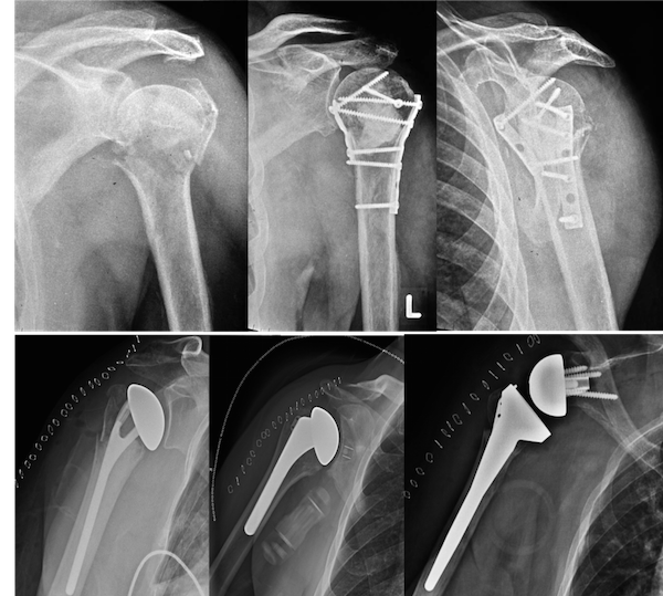 Left Humerus Fracture Surgical Neck Of The Humerus Wikipedia