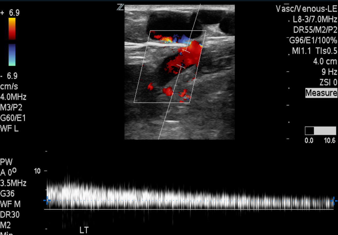 Venous Insufficiency | Michael Cumming, MD, MBA