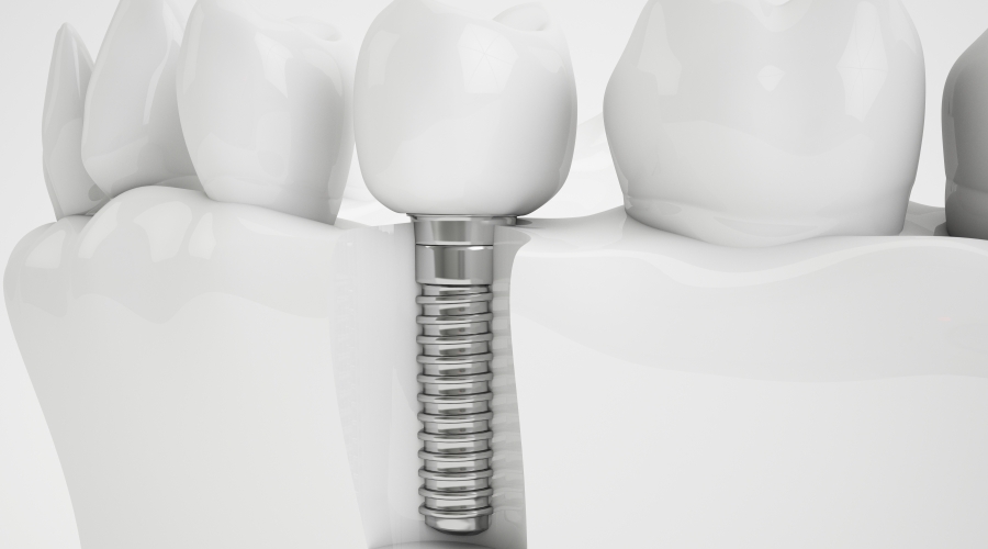 7 Advantages of Dental Implants | Murray Dental Group