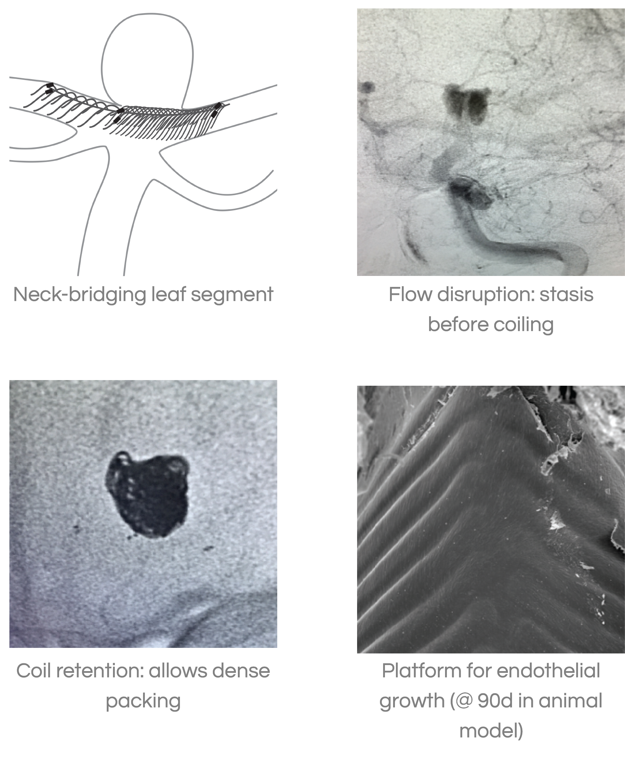 eCLIPs Features - Medical Devices for Cerebral Aneurysm