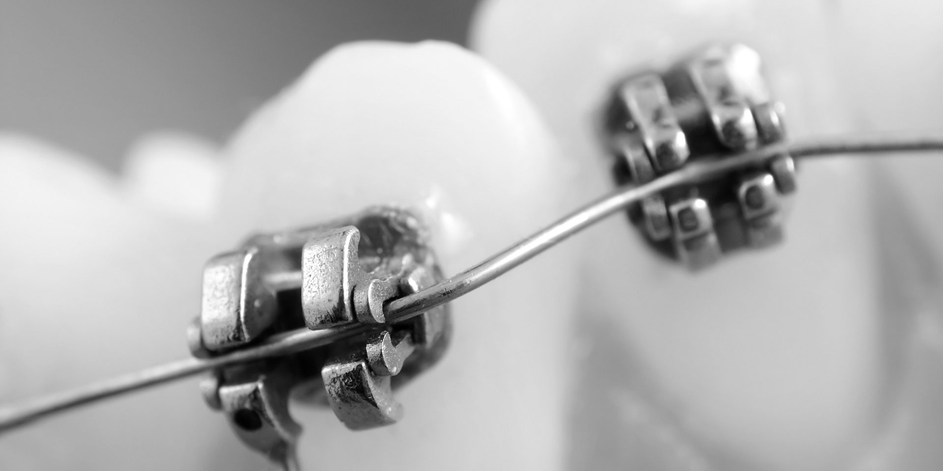 Orthodontic Braces | Dayton Dental Collaborative