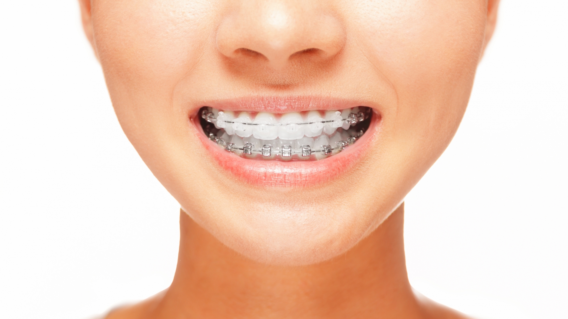 Adult Orthodontic Services - Great Lakes Dental