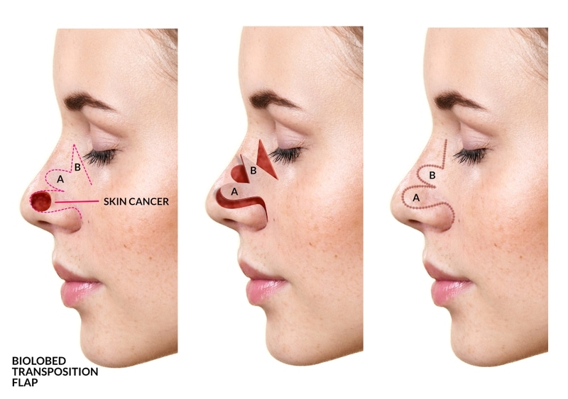 Face Cancer Surgery Tauranga | Rotorua | Nose Cancer Surgery | NZ