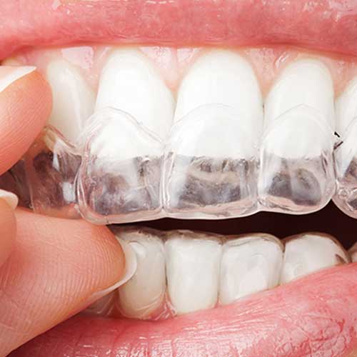 How Invisalign® Creates Beautifully Straight Smiles | Greentree Dental ...