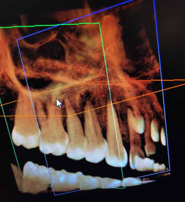 Abscess Tooth Xray