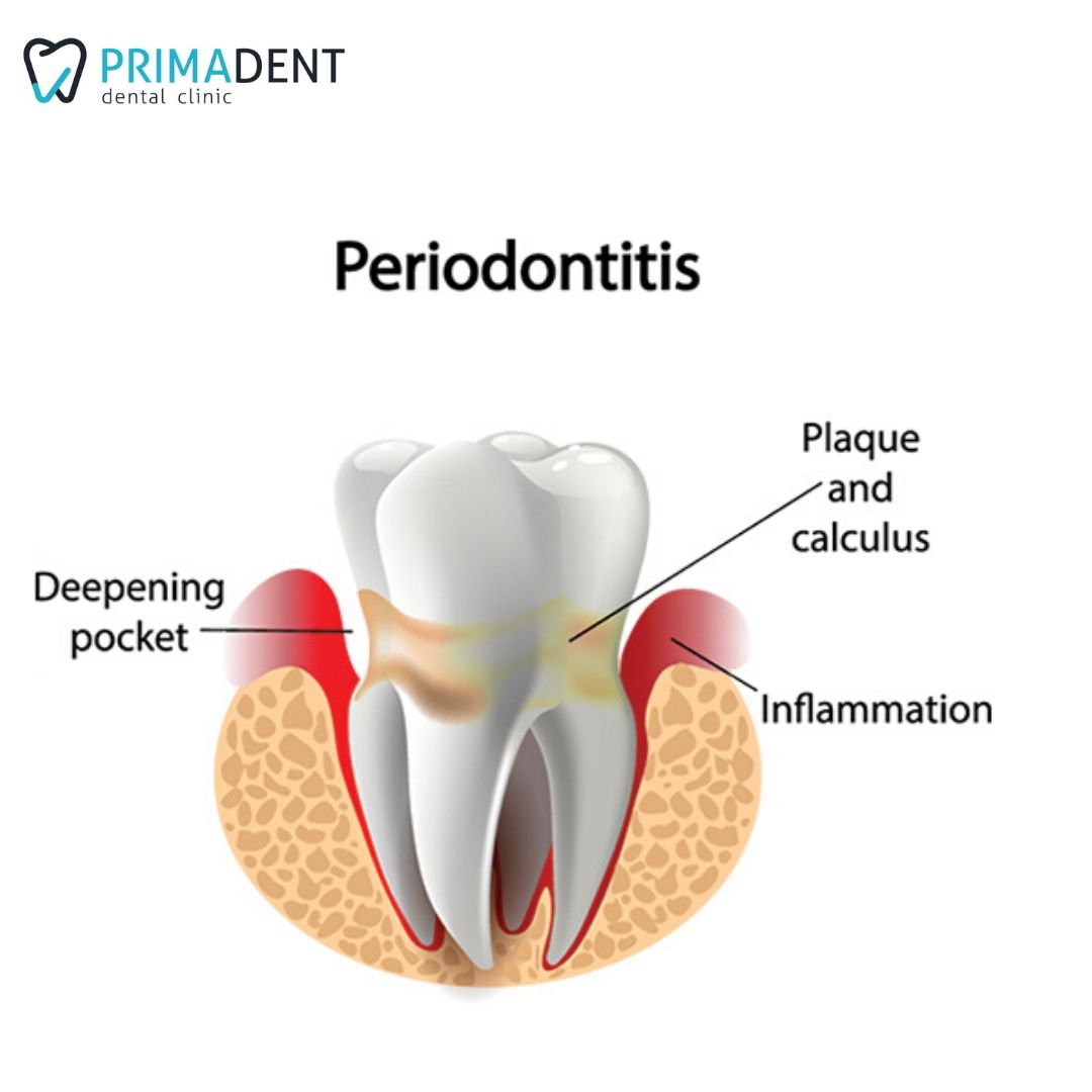 Paradontoza, Zdravljenje paradontoze