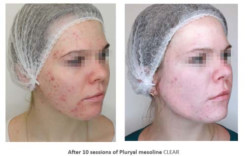 Mesoterapi | Vanity Beauty Clinic