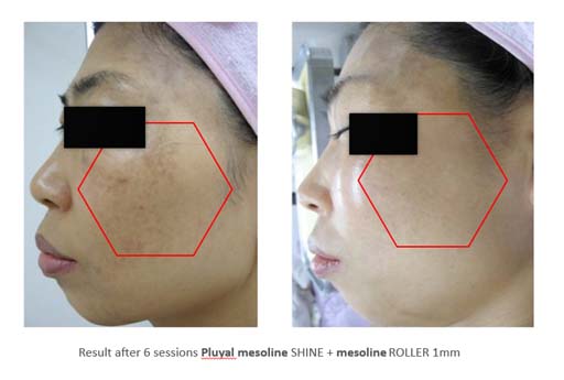 Mesoterapi | Vanity Beauty Clinic