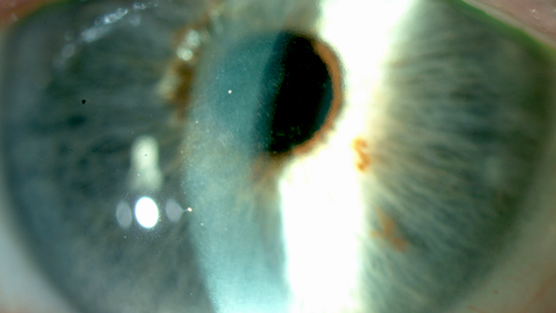 What is Fuchs' Dystrophy - Eyedeal Vision explains Fuchs' Dystrophy.