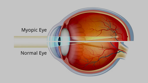 What is Myopia - Eyedeal Vision explains Myopia.