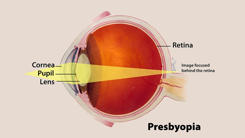 What is Presbyopia - Eyedeal Vision explains Presbyopia.