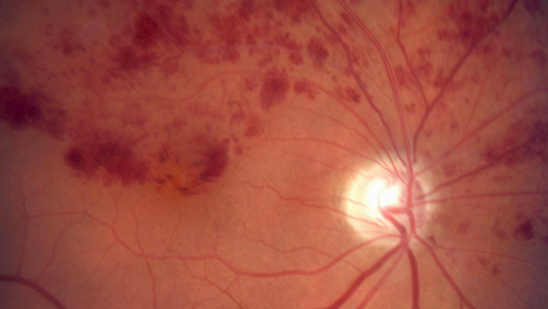 What is Retinal Vein Occlusion - Eyedeal Vision Explains Retinal Vein ...