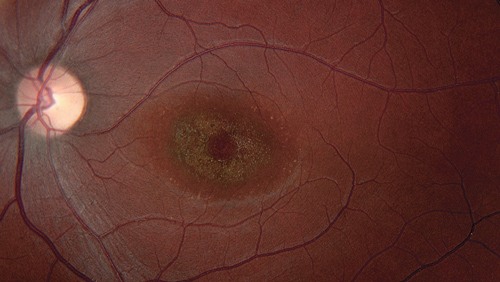 What is Stargardt Disease - Eyedeal Vision Explains Stargardt Disease.
