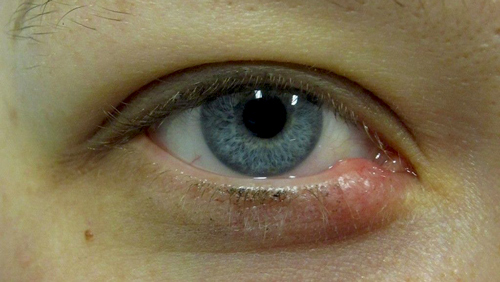 What is Styes - Eyedeal Vision Explains Styes.