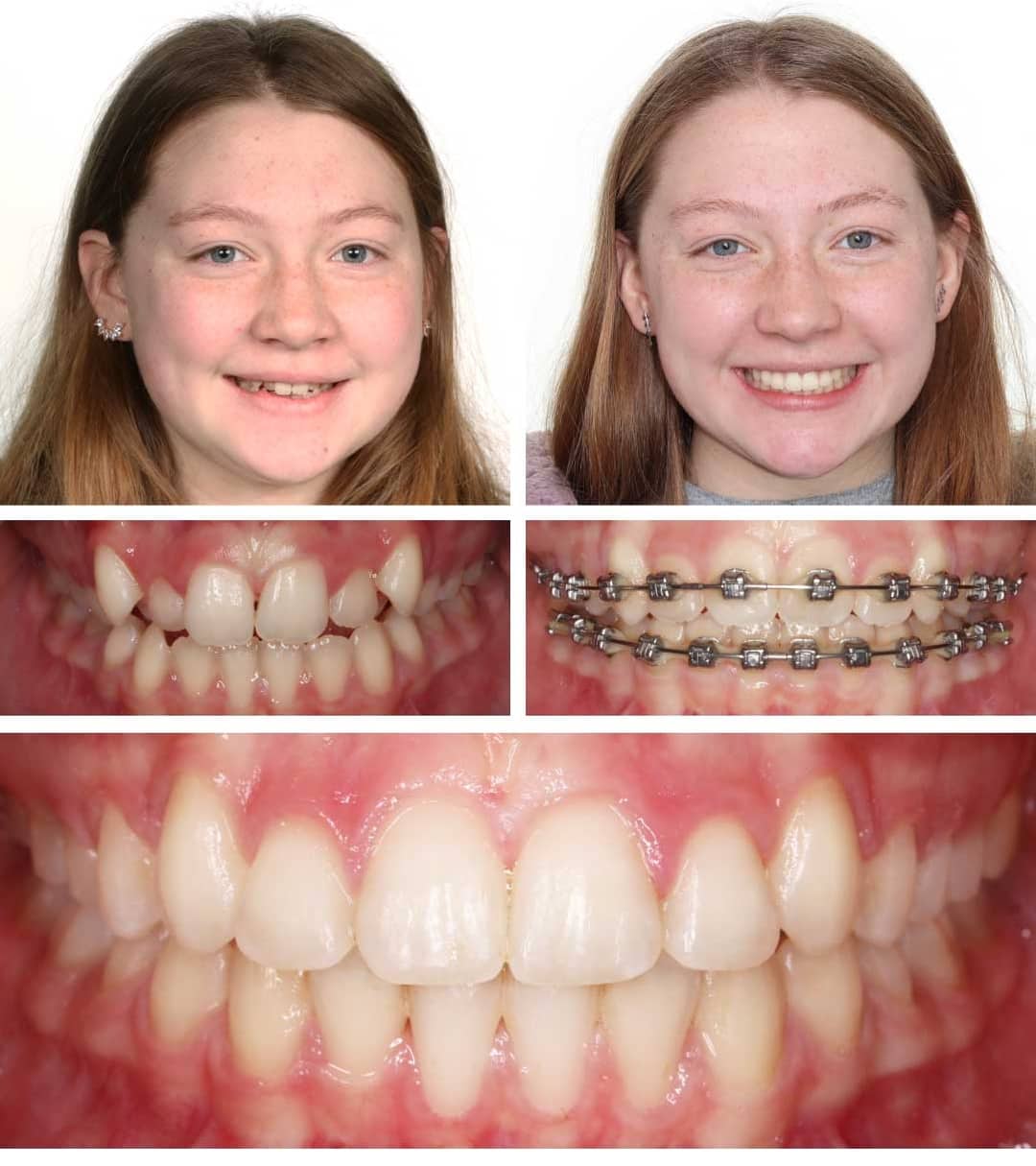 Orthodontics in Kansas City ,Gladstone Orthodontist ,Parkville ...