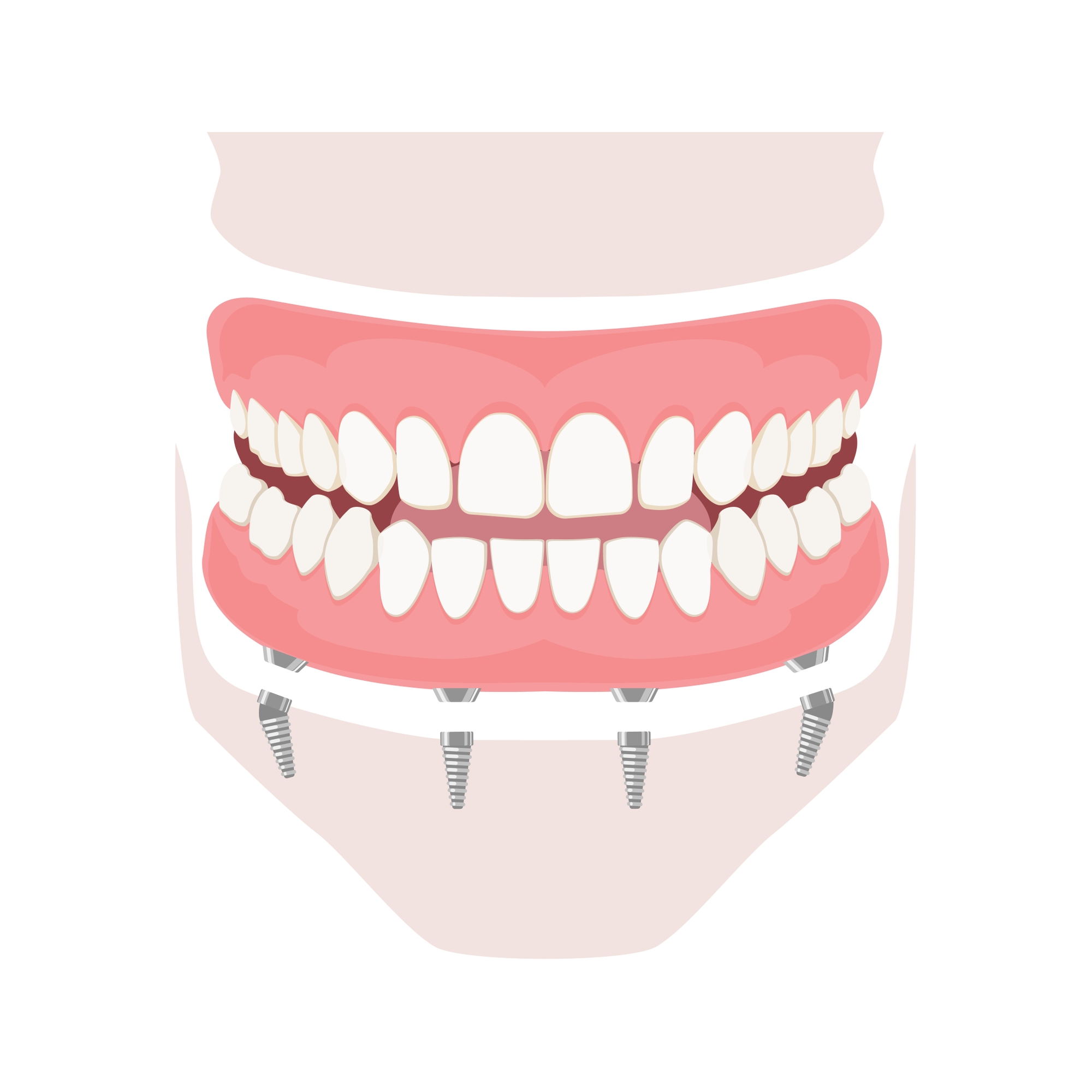 Full-Arch Implants | Jackson Family Dentistry