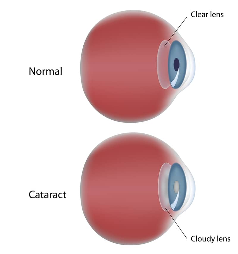 Eye Conditions
