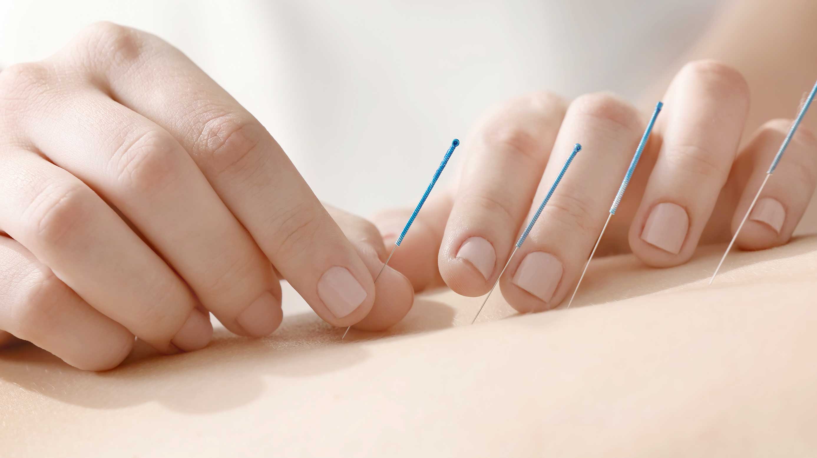 Acupuncture, Dry Needling & Gunn IMS | SW Calgary | Lakeview ...