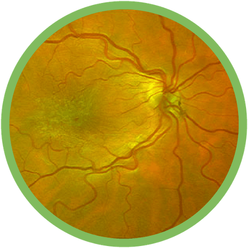 Colorado Retina: Treatment for Vitreoretinal Eye Disease