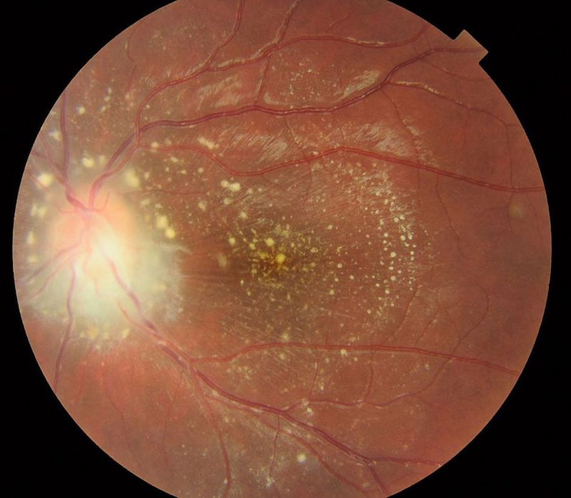 Colorado Retina: Uveitis