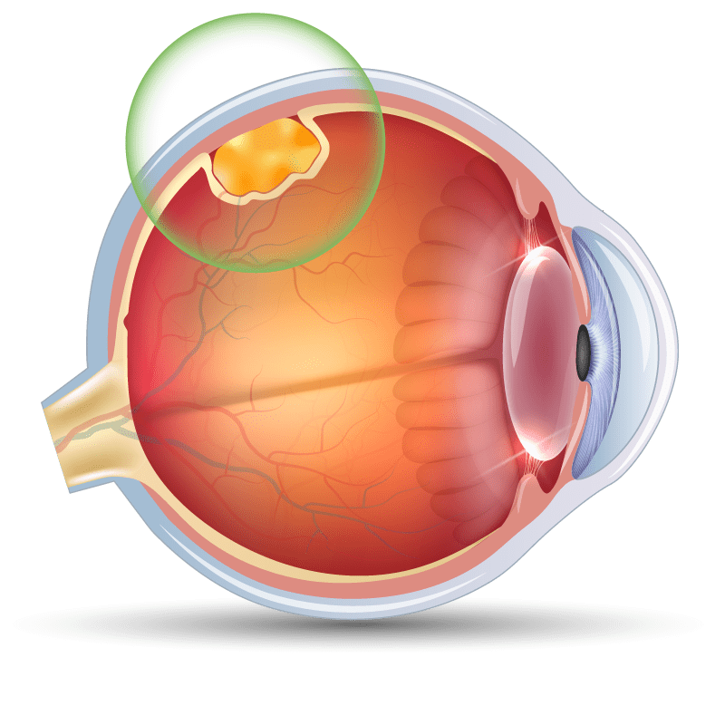 Colorado Retina: Retinal Conditions We Treat
