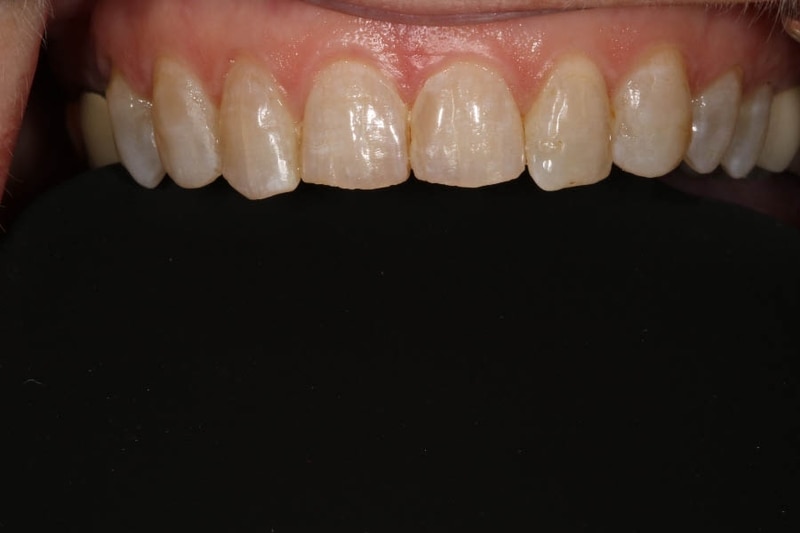 California, MD Dental Crowns & Bridges | Three Notch Dental