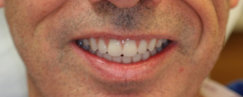 Festus Dentures | Williamson Dental