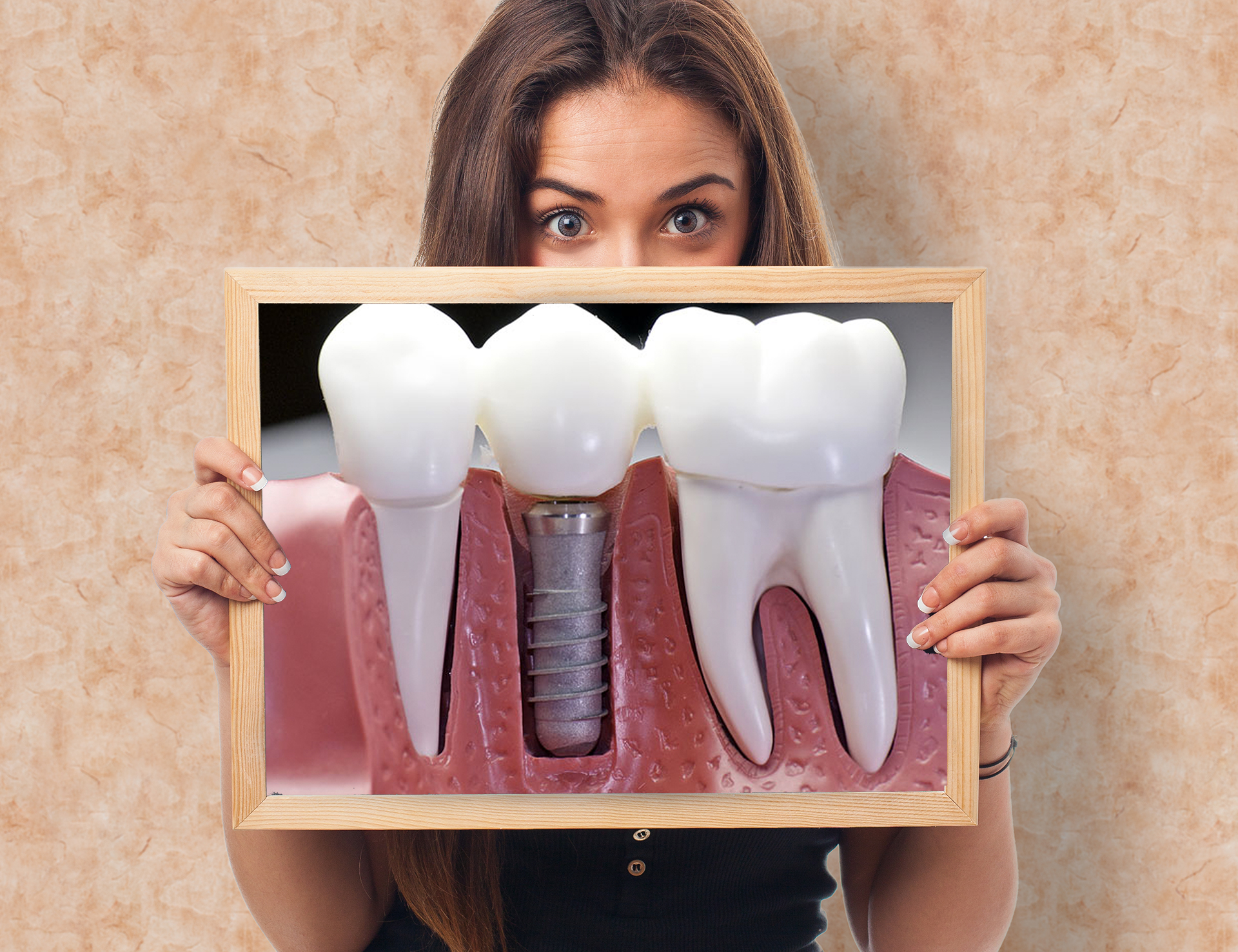 Single and All on 4 Dental Implants | Mandurah Dental Implant Clinic