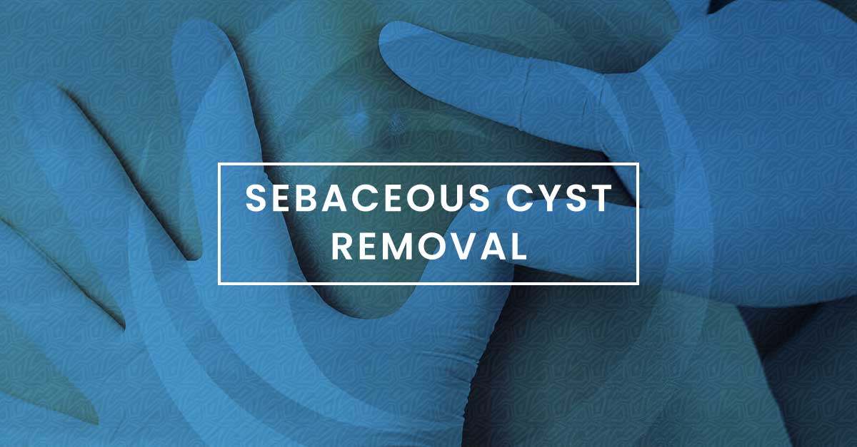 Sebaceous Cyst or Epidermoid In-office Treatment and Removal | Cyst Surgeon