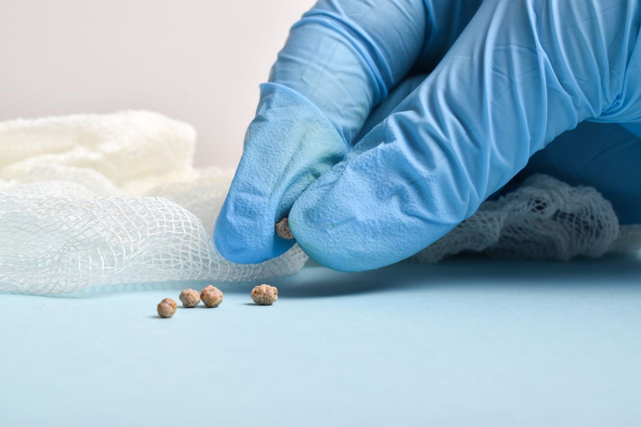 What to Know about Gallstones and How to Recognize When You’re at Risk