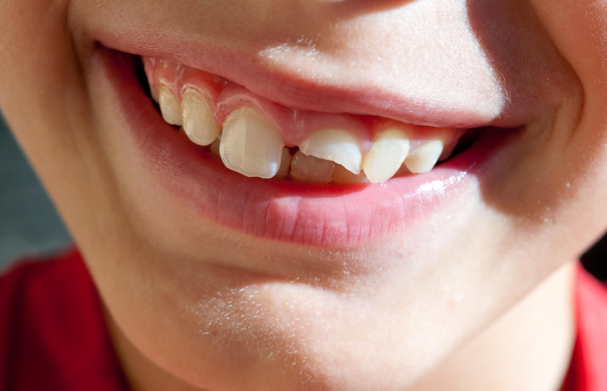 Why Do I Have Gapped Teeth? | TLC Dental