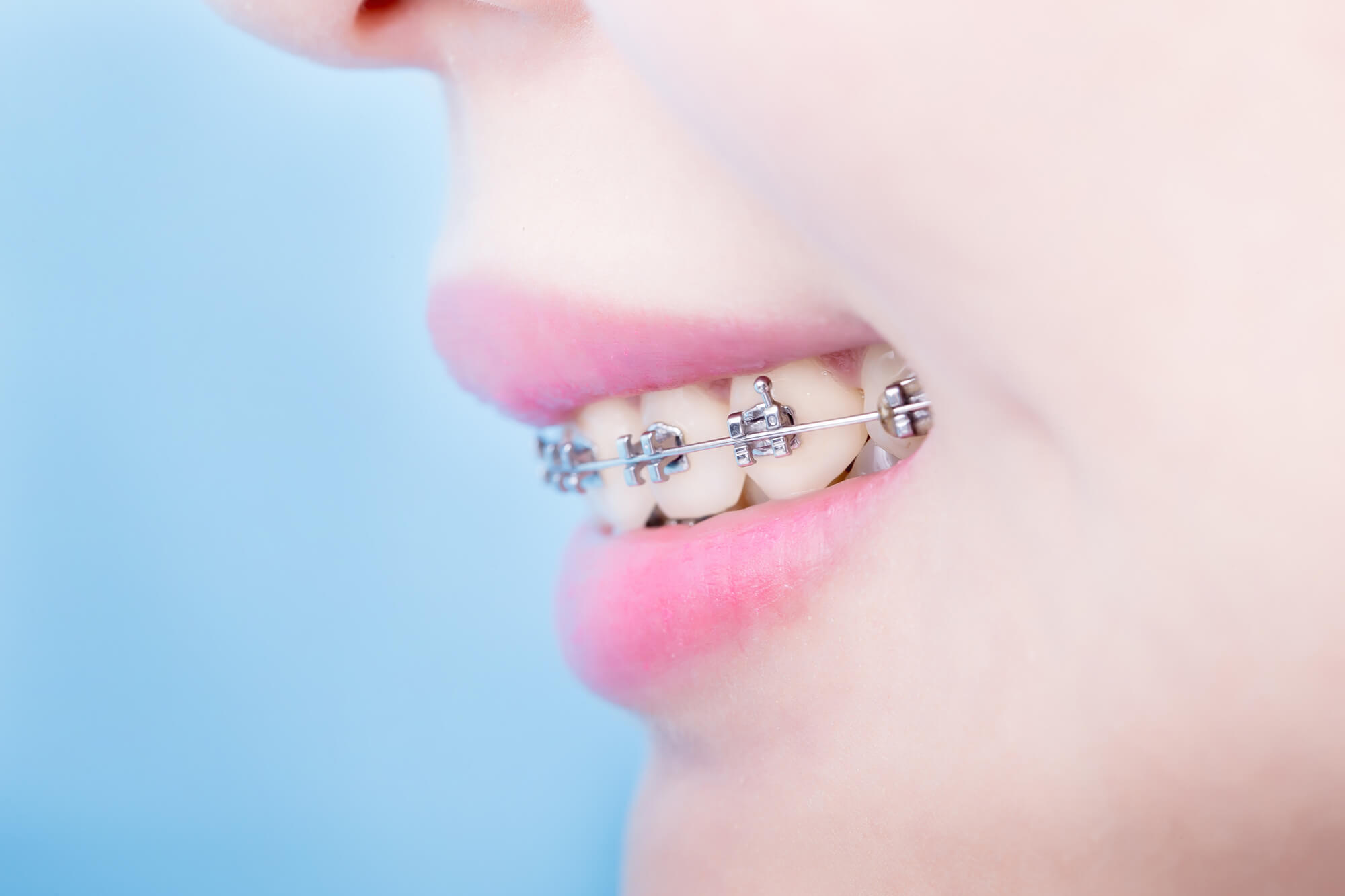 Braces: Learn About Their Different Parts | TLC Dental