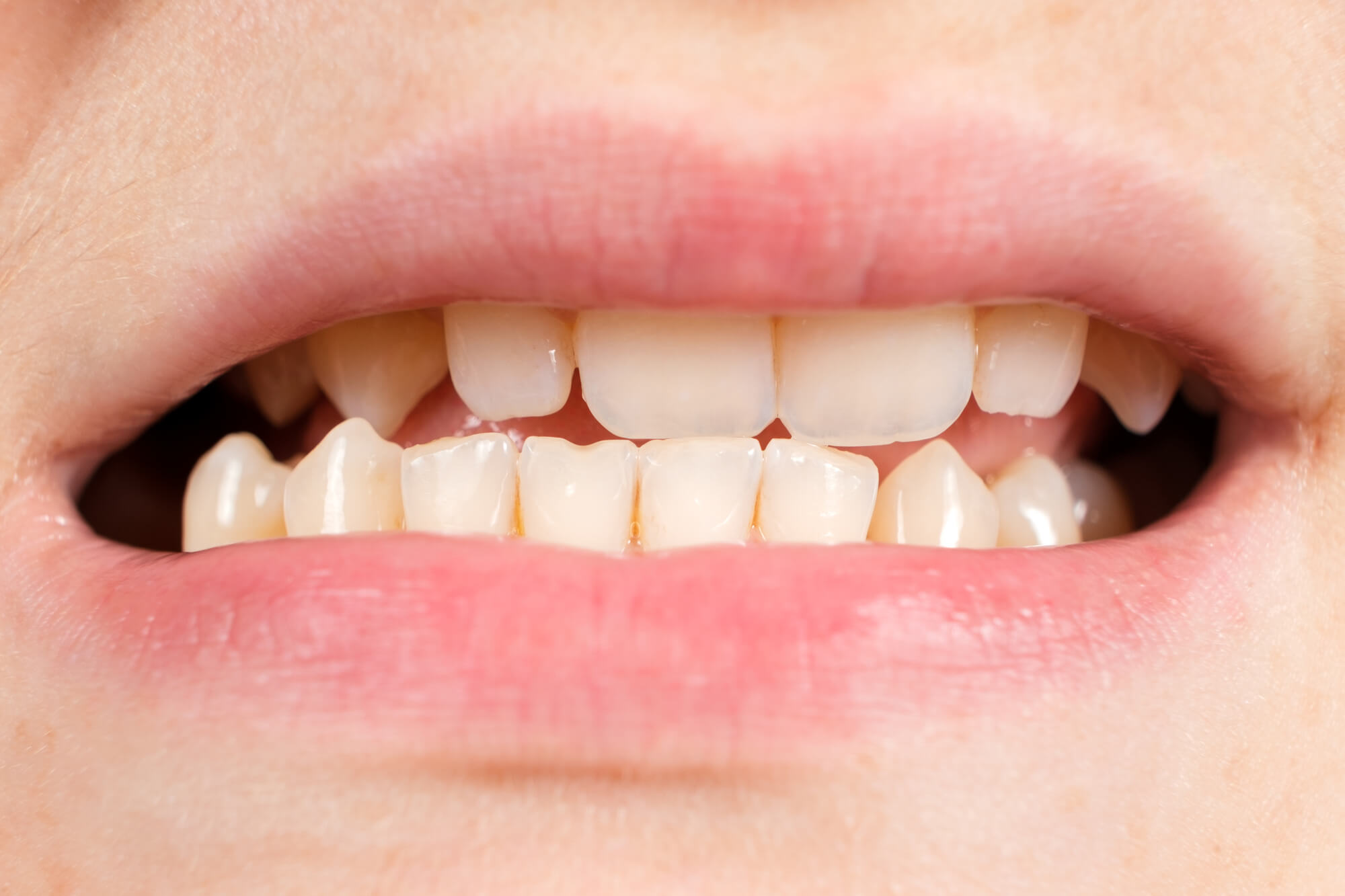 Understanding the Different Types of Dental Misalignment | TLC Dental