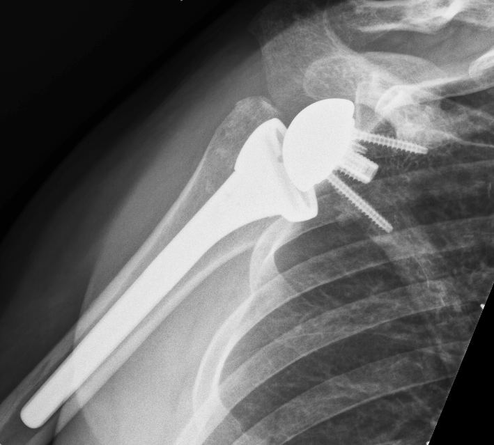 Reverse Total Shoulder Replacement - Shoulder Clinic