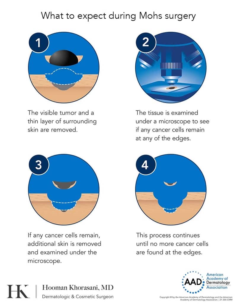 Mohs Skin Cancer Surgery Specialist | Cosmetic Surgeon NYC