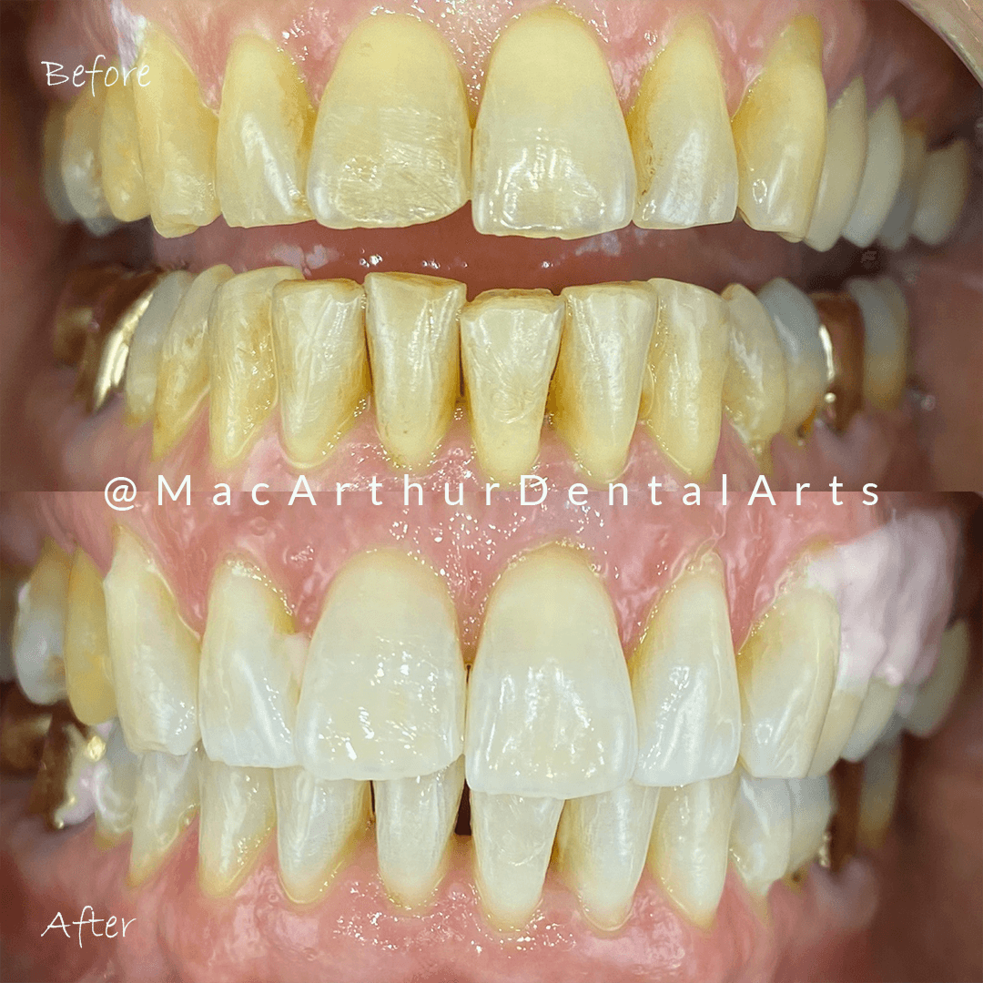 Whitening & ICON Resin Infiltration | MacArthur Dental Arts