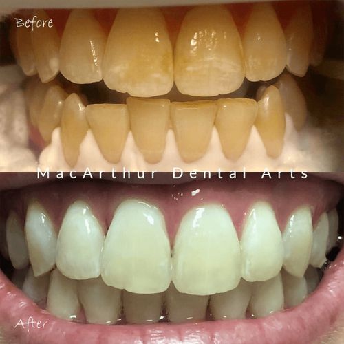 Whitening & ICON Resin Infiltration | MacArthur Dental Arts