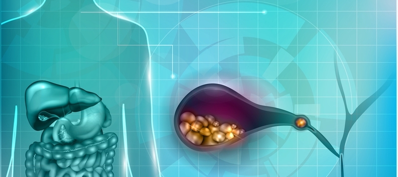 Gallestein: En komplett guide (Symptomer, behandling, operasjon)