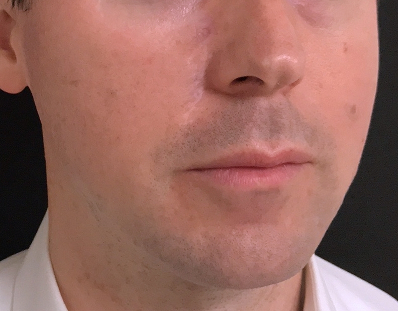 Before & After Photos Mohs Surgery Forehead 6 | NYC