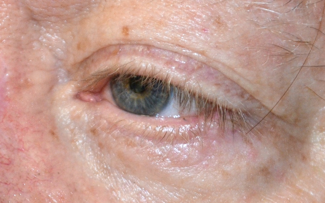 Before & After Photos Mohs Surgery Lip & Chin | NYC