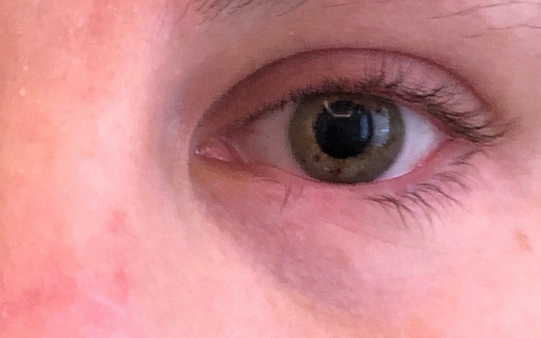 Before & After Photos Mohs Surgery Ear 3 | NYC