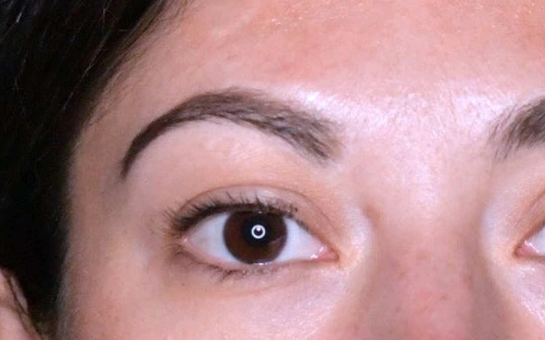 Before & After Photos Mohs Surgery Ear 3 | NYC