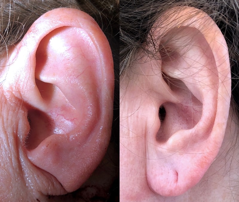 Before & After Photos Earlobe Repair 3 | NYC