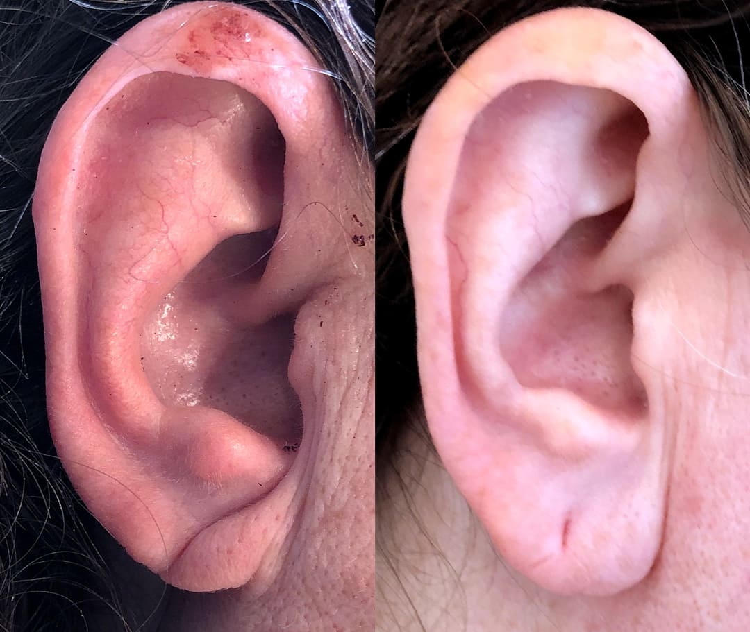 Before & After Photos Earlobe Repair 3 | NYC