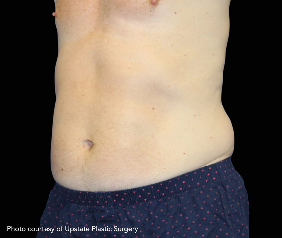 Before & After Photos Muscle Sculpting 12 | NYC