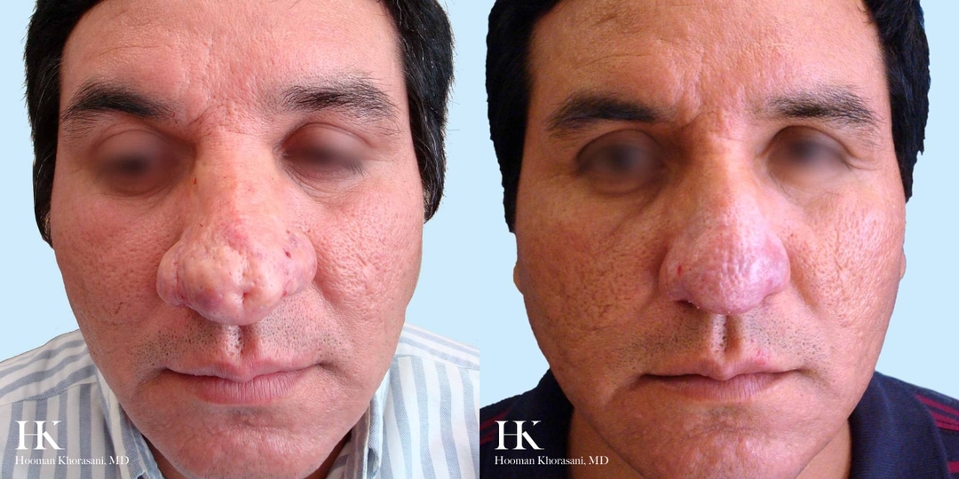 Rhinophyma Treatment Options | Dr. Khorasani