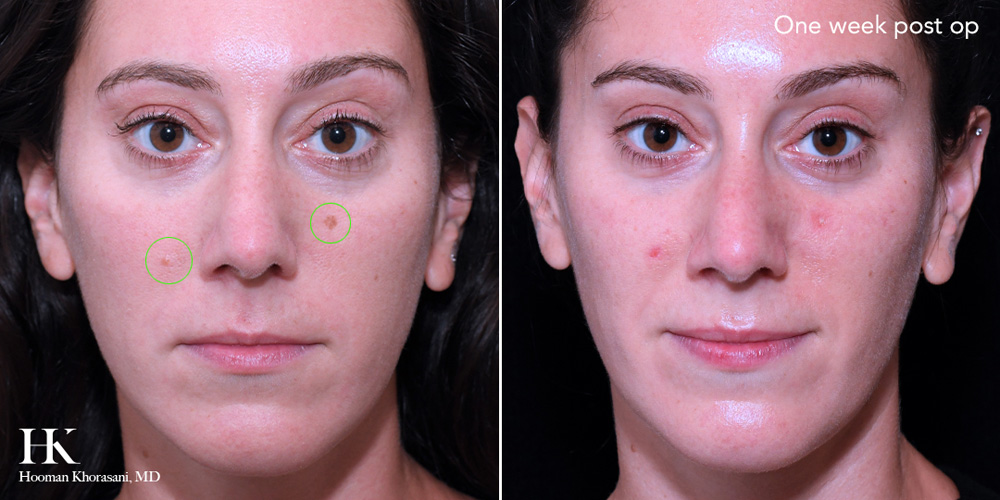 Dermatologist Treatment for Dark Spots on the Face: A Beginner’s Guide