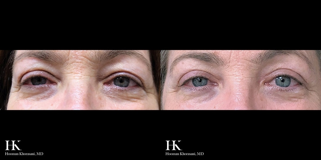 Before & After Photos Eyelid Surgery Upper | Cosmetic Surgeon NYC