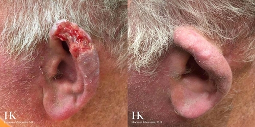 Before & After Photos Mohs Micrographic Surgery & Reconstruction ...