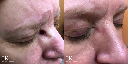 Before & After Photos Mohs Micrographic Surgery & Reconstruction ...